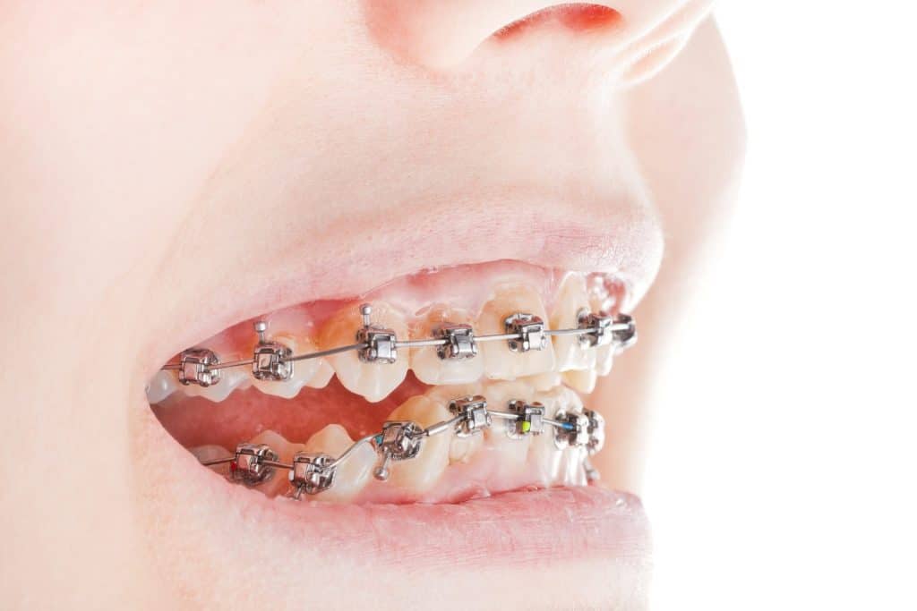 Benefits of Orthodontics – TinGrinners Club Jamaica