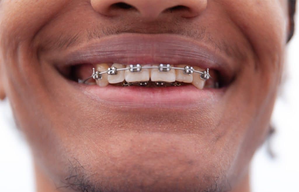 Self-Ligating Braces – TinGrinners Club Jamaica